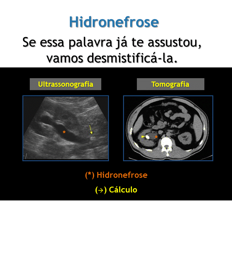 Hidronefrose: Vamos desmistificar esse termo | o urologista