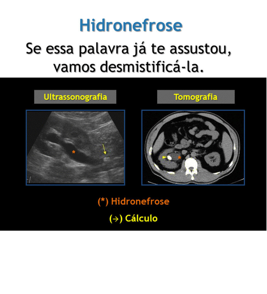 Hidronefrose e os Riscos ao Rim - Podcast O Urologista | o urologista